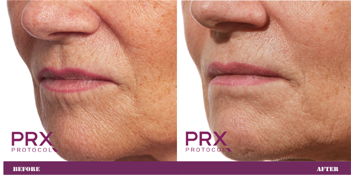 PRX-T33 Bio Stimulator | Boston Area | Dr. Happe Medical Aesthetics